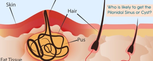 Pilonidal Sinus Treatment in Nashik | Dr. Sachin Deore